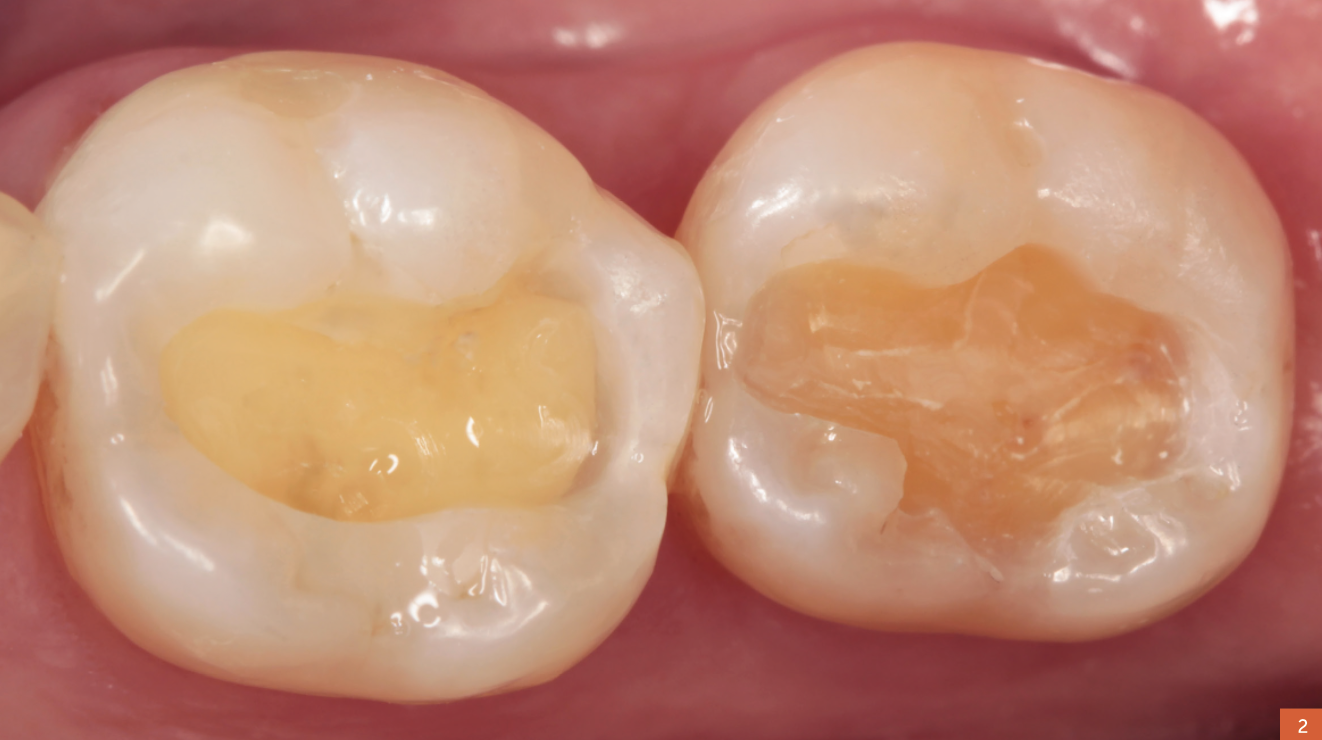 Protocolo de restauración para resina compuesta en dientes posteriores