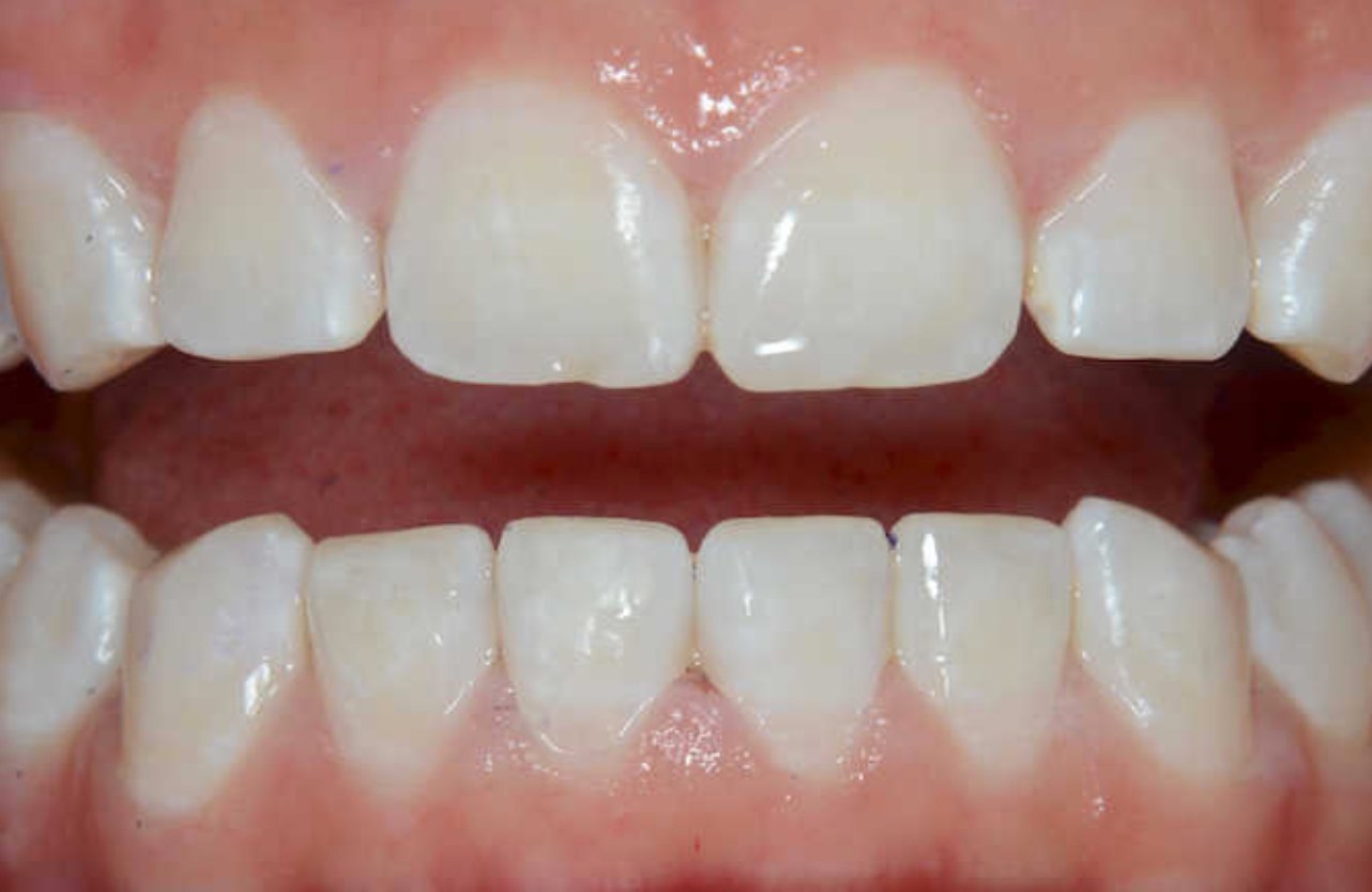 La Microabrasión en Odontología Estética