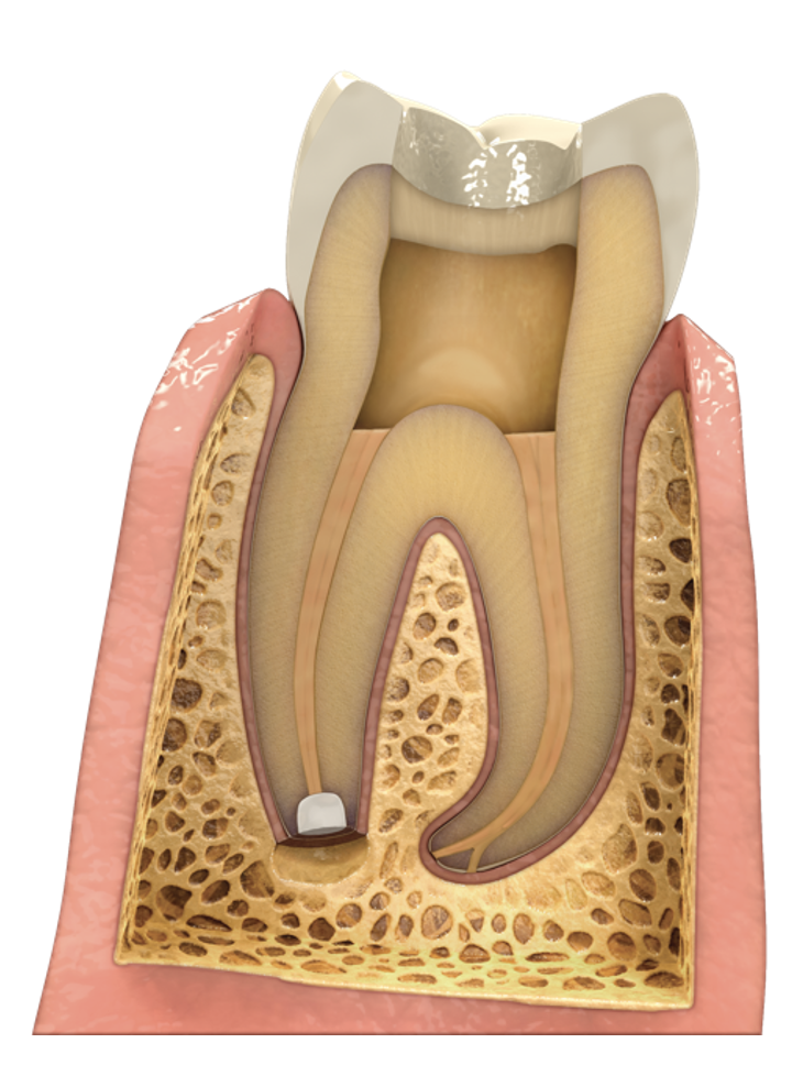 Procedimientos y beneficios del cemento MTA en su consultorio