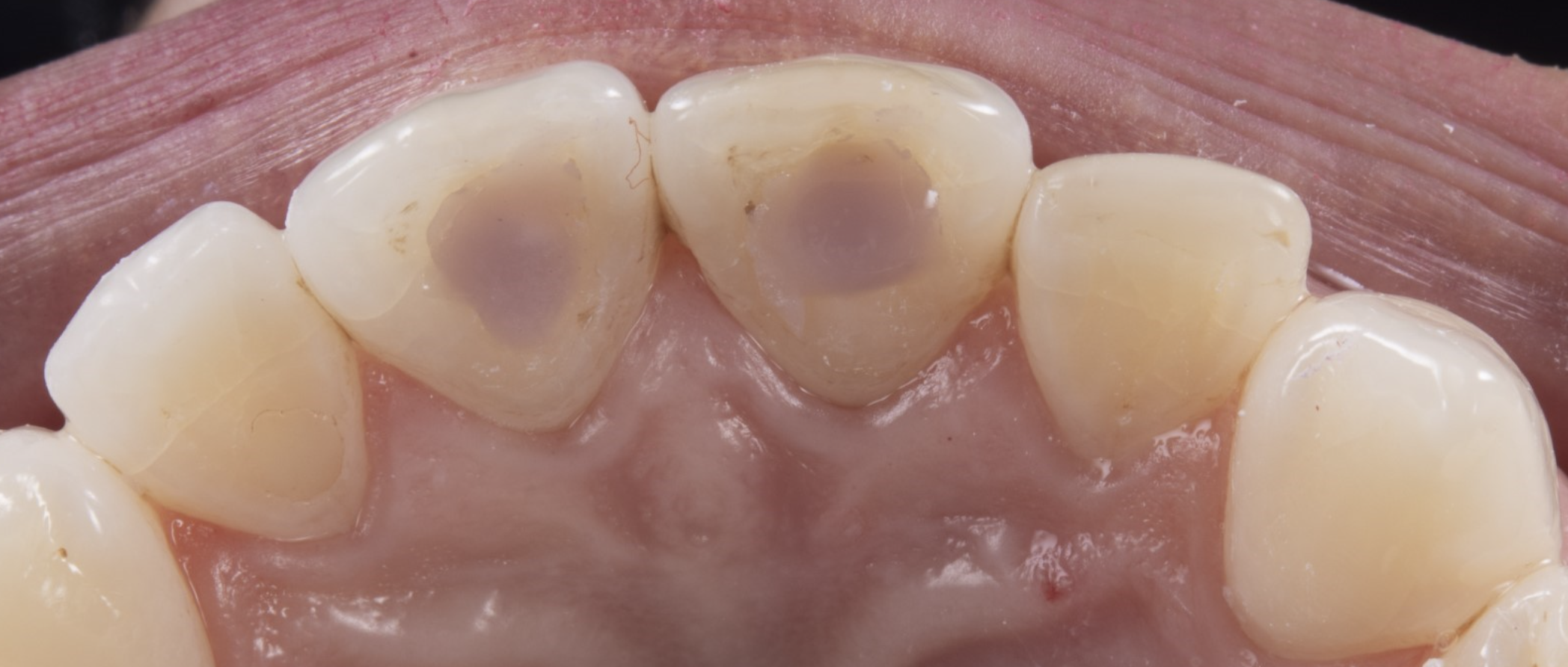 PermaFlo Pink: Una Herramienta Esencial para el Odontólogo Moderno