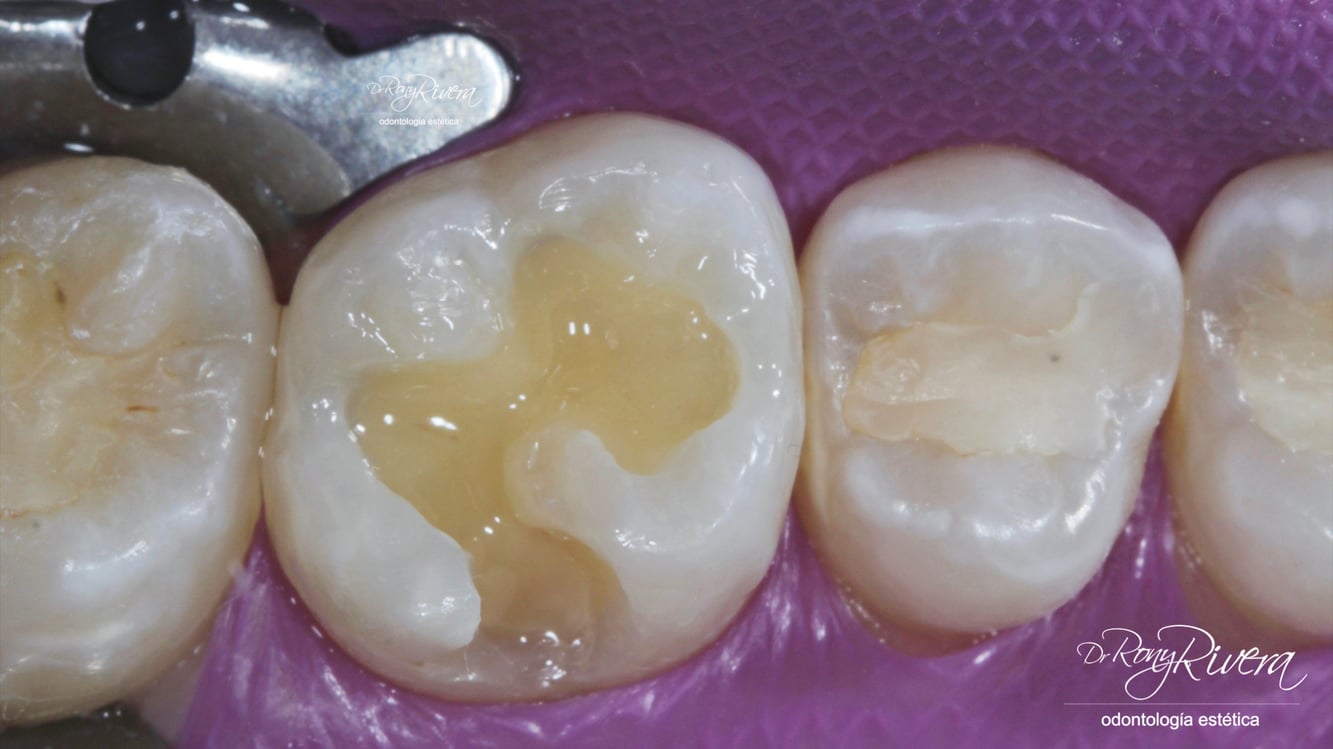 Recreando la anatomía dental con resina compuesta: Efecto camaleón y ...