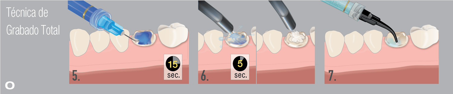 ¡Primer para zirconia y metal en 12 pasos!