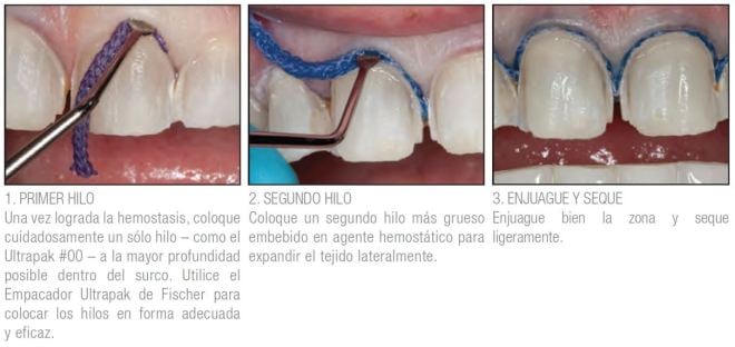 Dominando la aplicación del hilo retractor