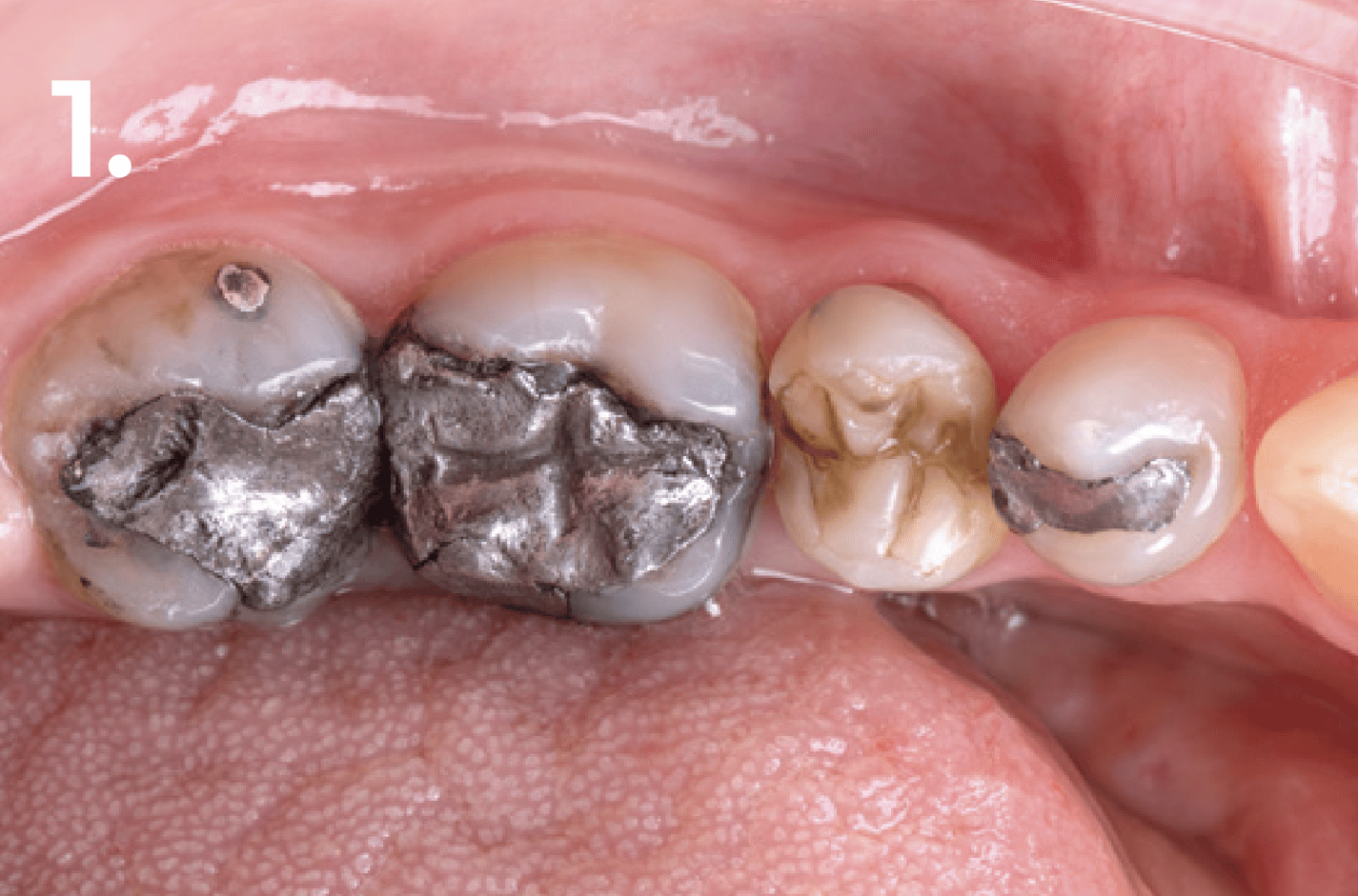 Guía Clínica de FORMA: Resina compuesta nanohíbrida con zirconia