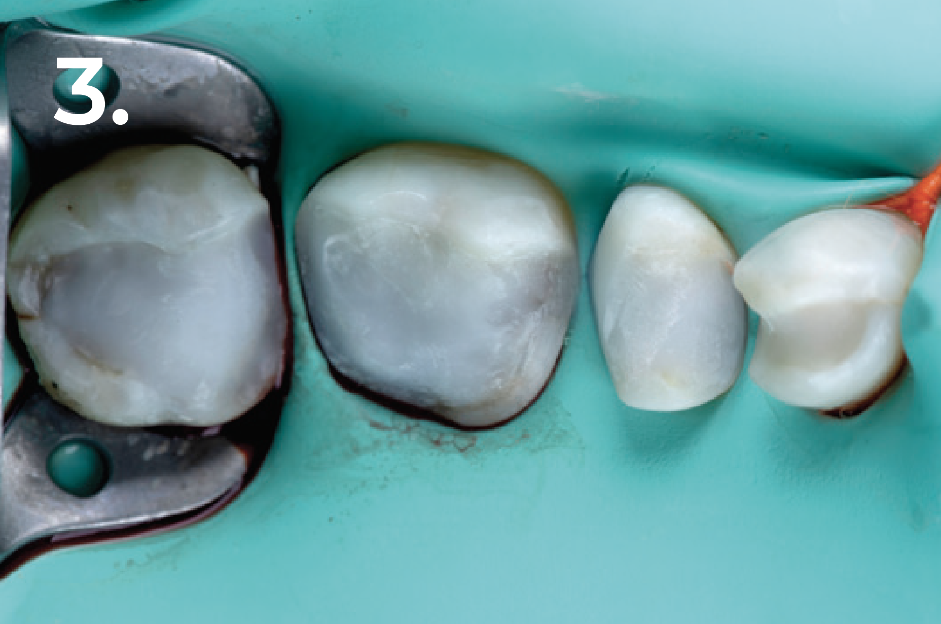 Guía Clínica de FORMA: Resina compuesta nanohíbrida con zirconia