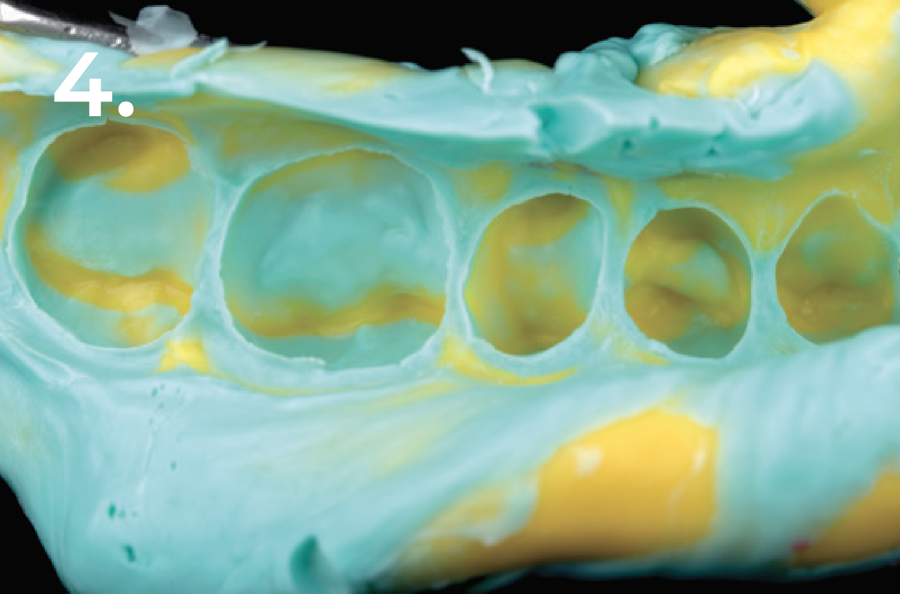 Guía Clínica de FORMA: Resina compuesta nanohíbrida con zirconia