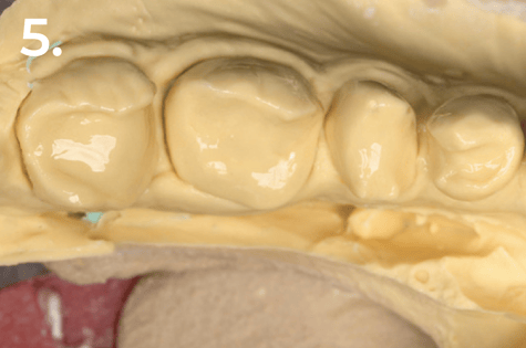 Guía Clínica de FORMA: Resina compuesta nanohíbrida con zirconia