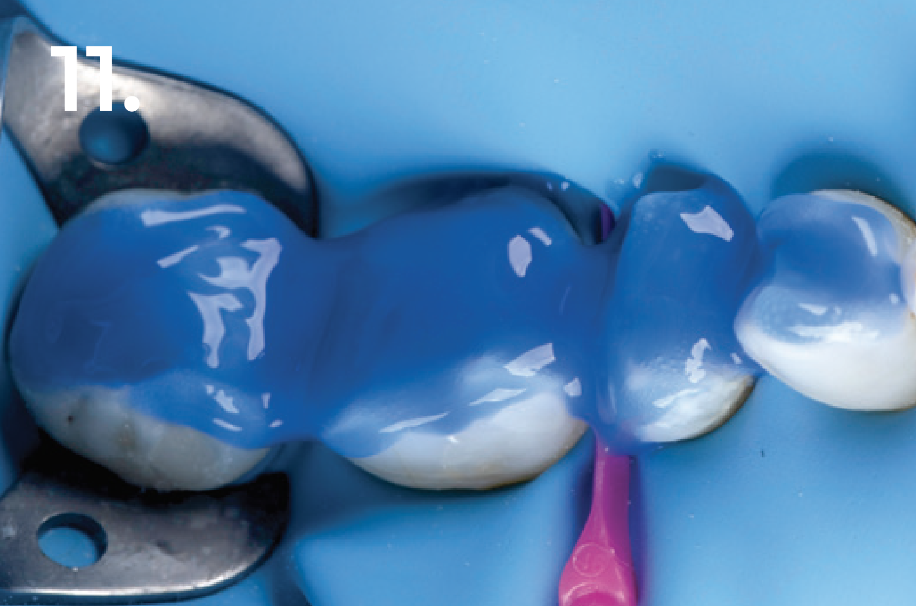 Guía Clínica de FORMA: Resina compuesta nanohíbrida con zirconia