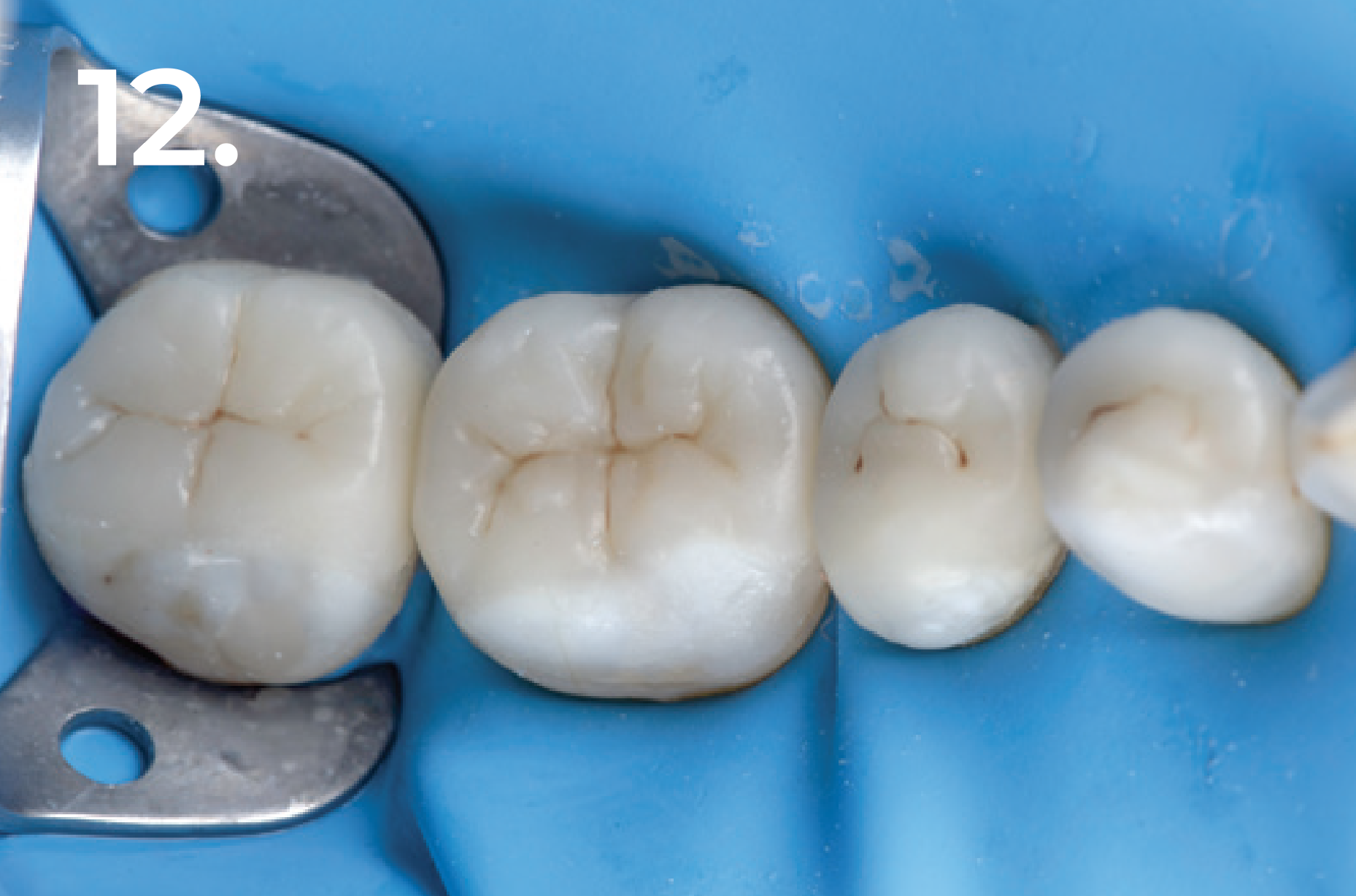 Guía Clínica de FORMA: Resina compuesta nanohíbrida con zirconia