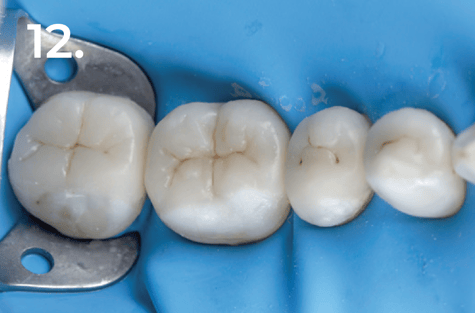 Guía Clínica de FORMA: Resina compuesta nanohíbrida con zirconia