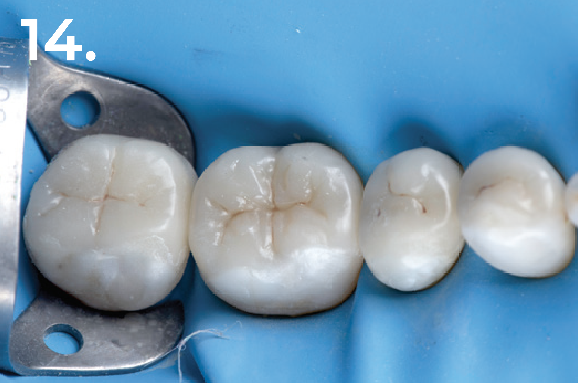 Guía Clínica de FORMA: Resina compuesta nanohíbrida con zirconia