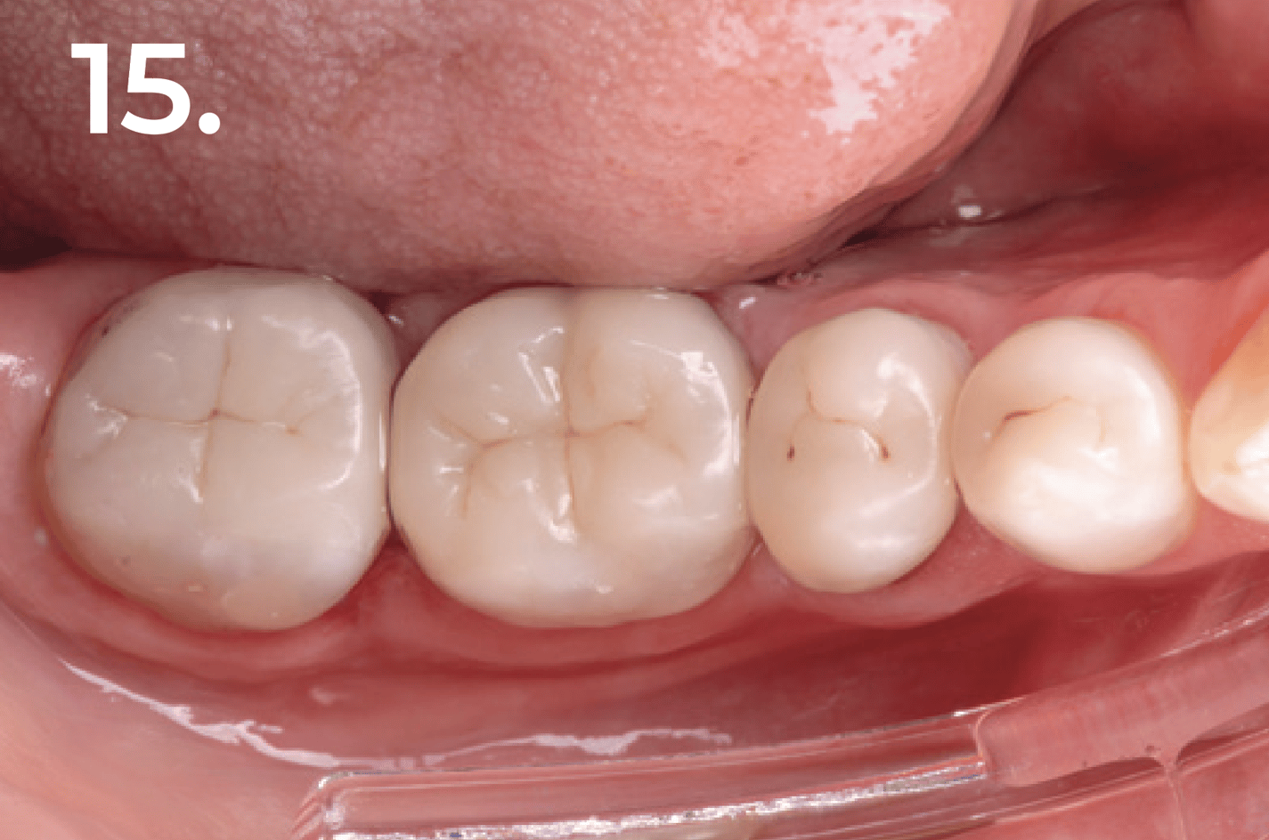 Guía Clínica de FORMA: Resina compuesta nanohíbrida con zirconia