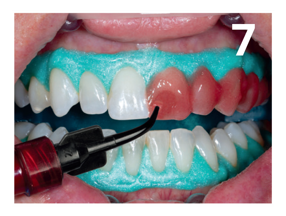 Guia técnica: Manejo adecuado de Opalescence Boost